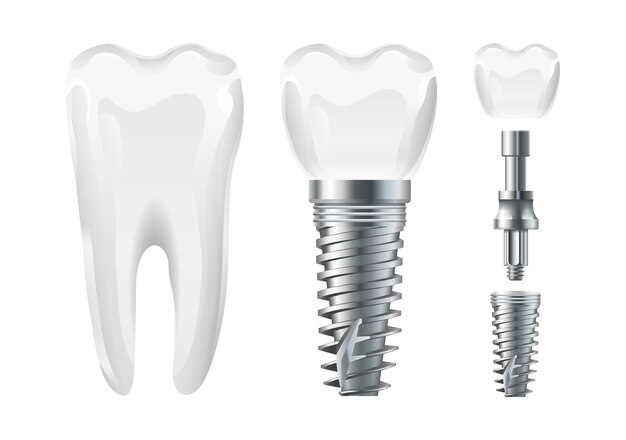 Dịch vụ trồng răng Implant - Giải pháp cho người mất răng